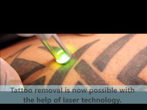 Plastic Surgery Inland Empire Introduces Laser Techniques for Tattoo Removal and Skin Tightening