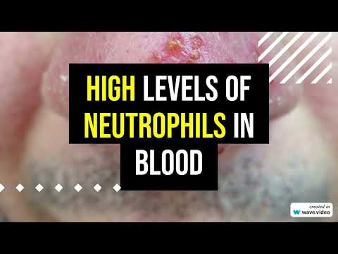 High levels of neutrophils in blood: Main neutrophilia reasons!