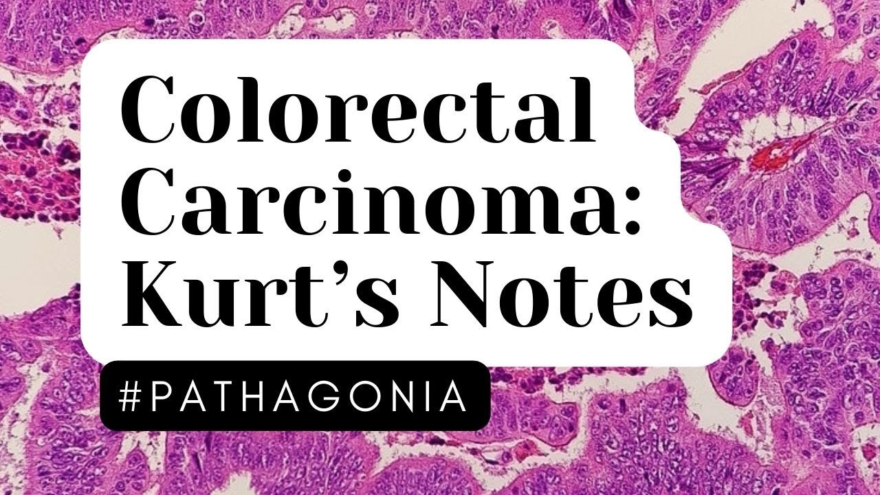 Colon Cancer: Kurt’s Notes #pathagonia