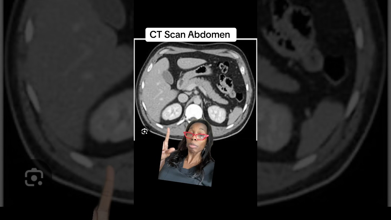 Surprising Reasons You Might Need an Abdomen CT Scan!