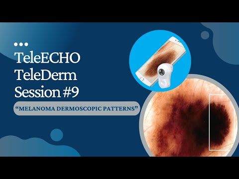 TeleECHO TeleDerm Session #9 - Melanoma Dermoscopic Patterns