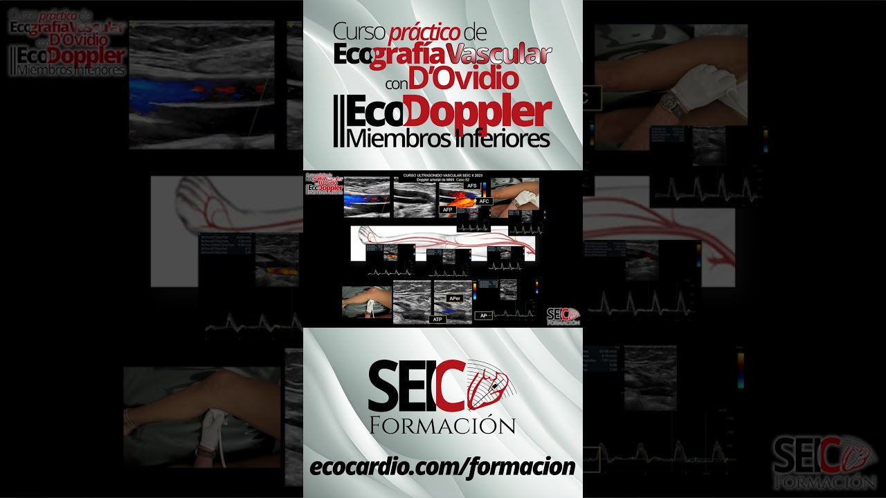 Curso Práctico de Ecografía Vascular - Eco Doppler Miembros Inferiores