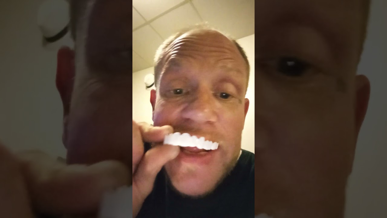 Temu Veneers ( y'all doing it way wrong) stop wearing the mold , read directions