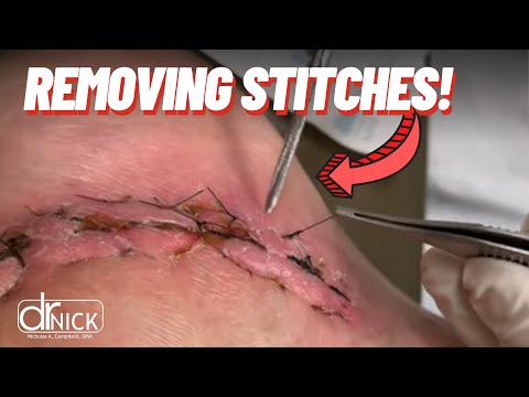 Expert Insights on Removing Stitches | Does it Hurt?!😳😬