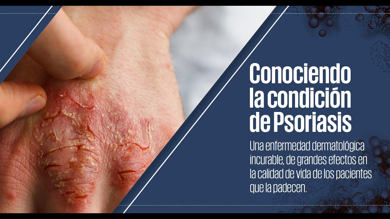 What is psoriasis?