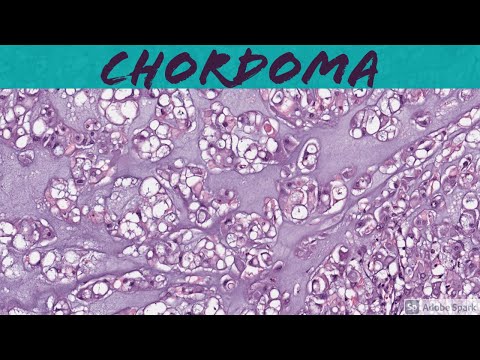 Chordoma: 5-Minute Pathology Pearls