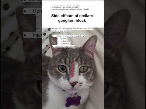 Side effects of stellate ganglion block