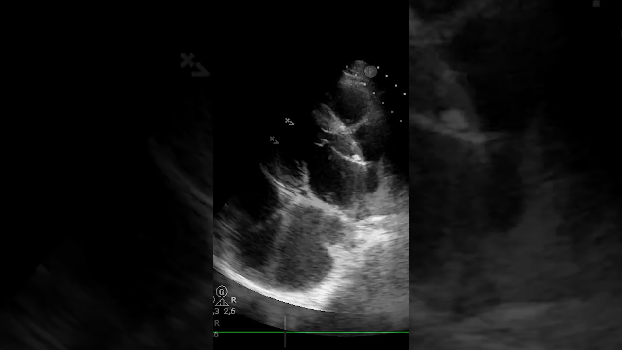 Diagnóstico diferencial derrame pericárdico o derrame pleural mediante ecocardiografía