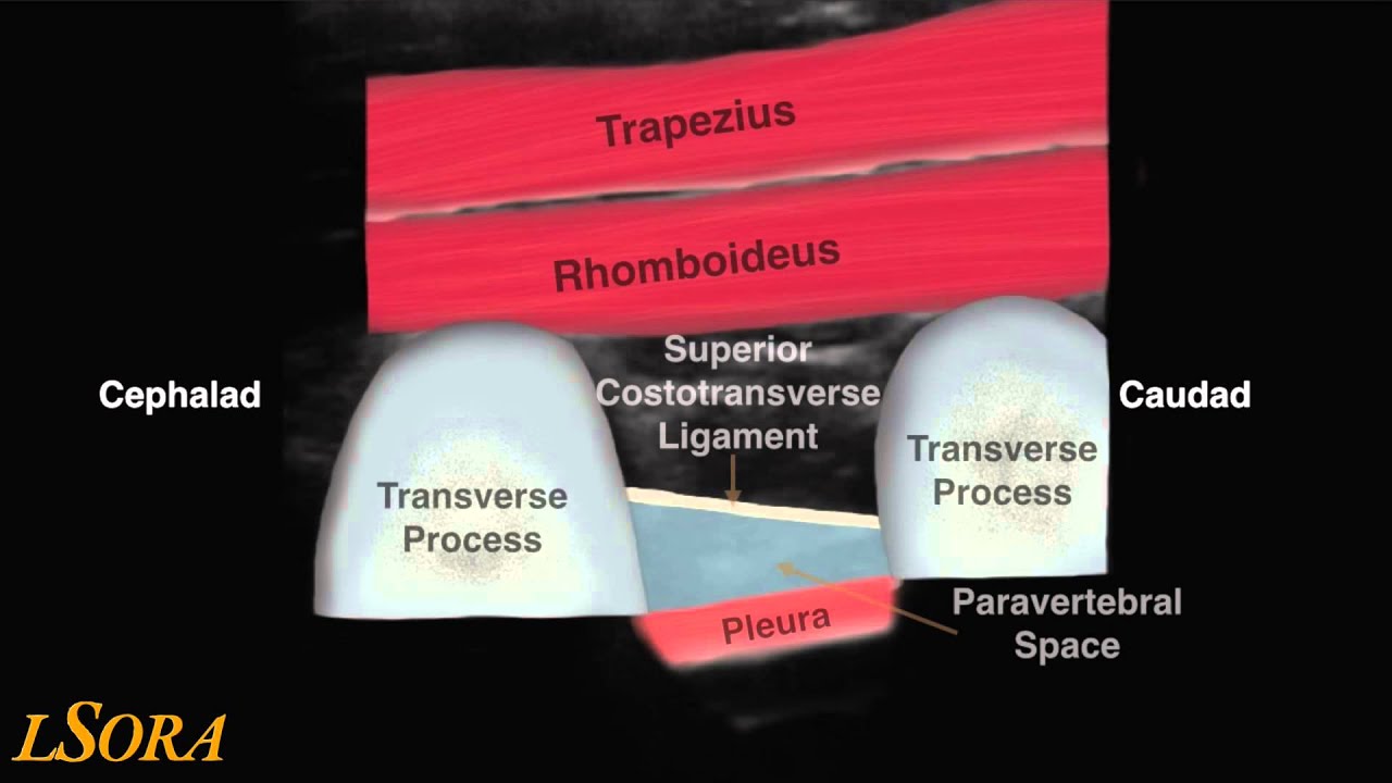 LSORA: paravertebral block (US guided) tutorial