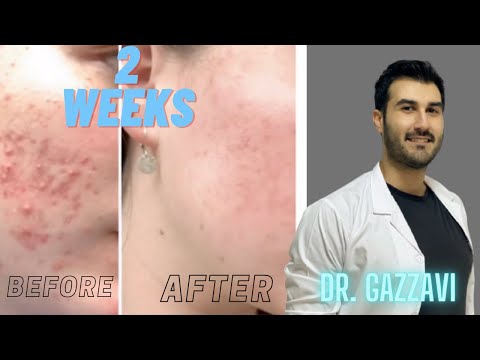 Research proven 97% ACNE Treatment with this method #Acnetreatment