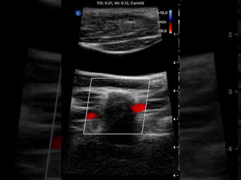 Vertebral Artery: Captured with Butterfly iQ™