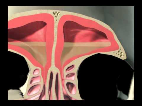Balloon Sinuplasty animation