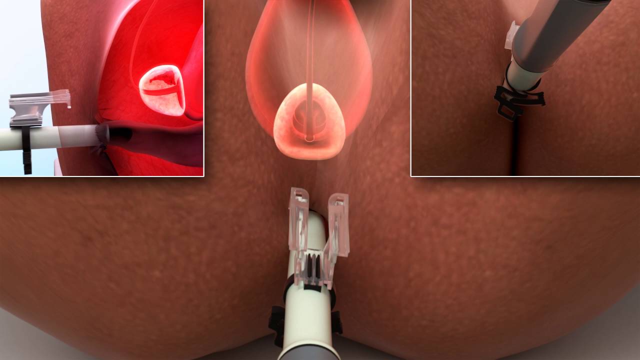 The PrecisionPoint™ Transperineal Access System (http://perineologic.com)