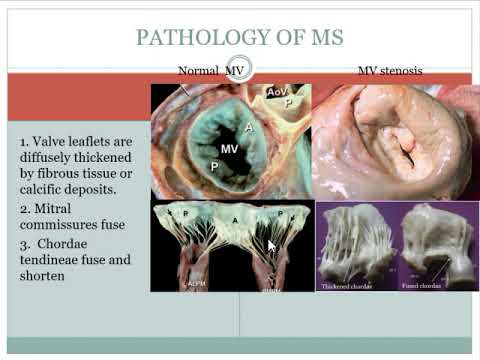 Valvular Heart Disease MS MR MVP
