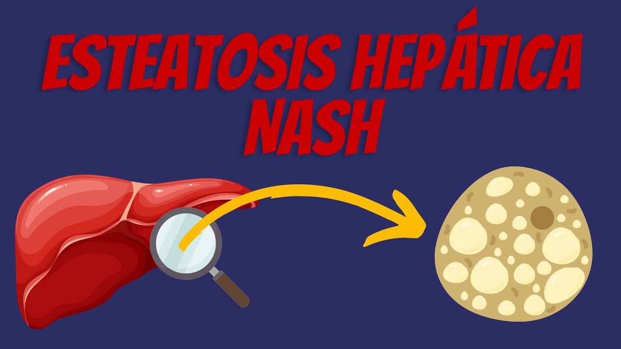 Esteatosis Hepática | NASH / MASLD