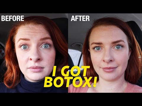 I Got Botox! My Experience with Dr. Dhir + Before and After