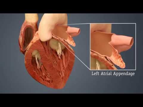 WATCHMAN LAAC Implant