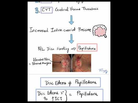 The 3 Important Causes of Papilledema #Shorts