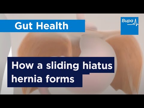 How a sliding hiatus hernia forms | Bupa Health