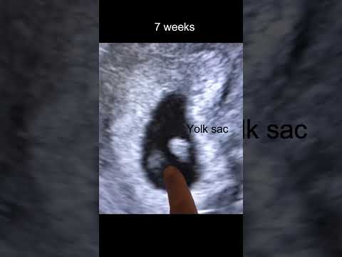 7 Weeks Pregnancy Ultrasound Scan | Wow moment #shorts #drsita #mindbodycare