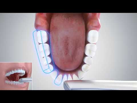 3M True Definition Scanner ALT Full Arch Animation