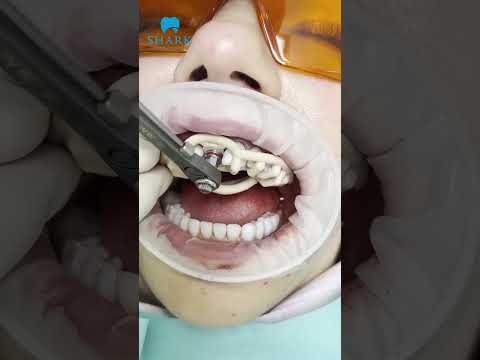 X-Guide Implant - Perfection does exist!