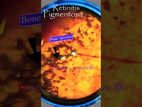 Retinitis pigmentosa | bone spicules | narrowed retinal vessels | Fundus | Short Video 208 #viral