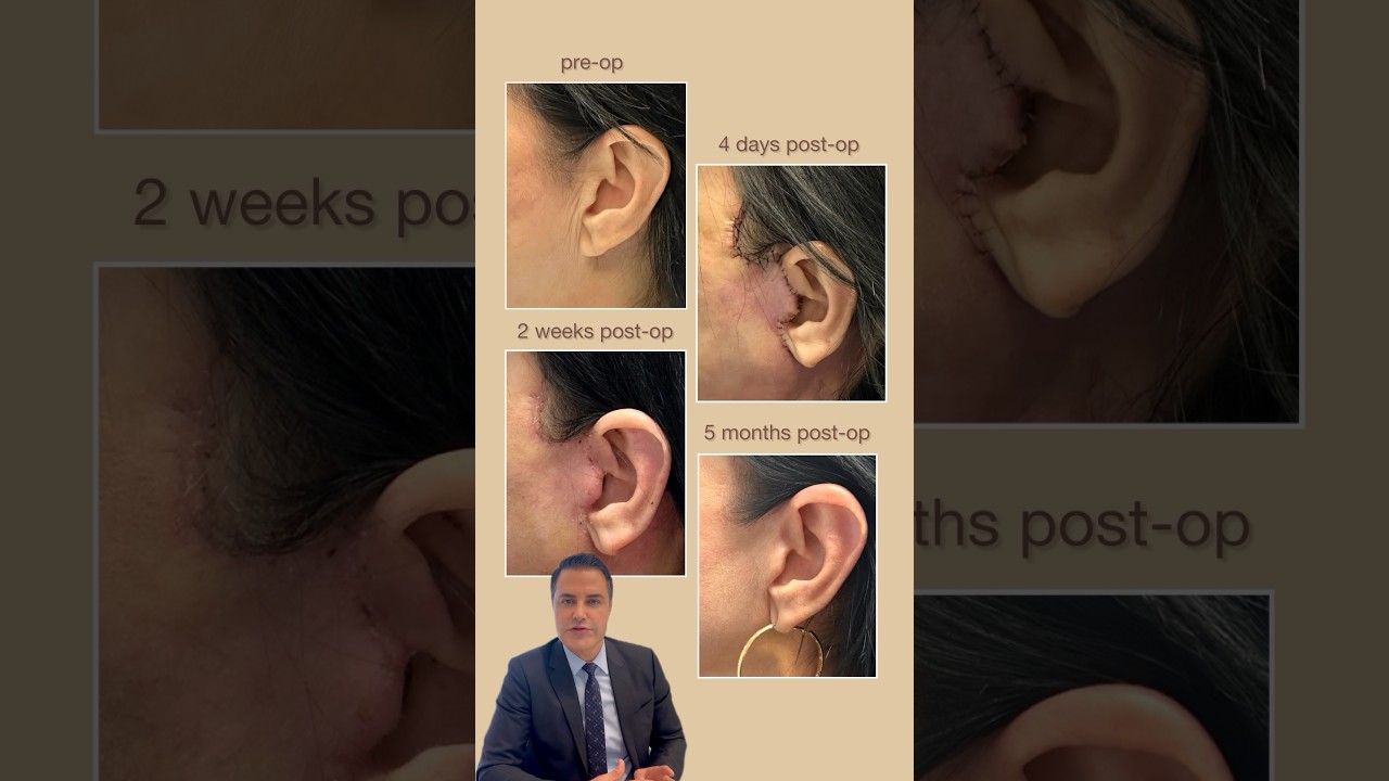 Can You Spot Her Facelift Scars? | Paul N. Afrooz, MD