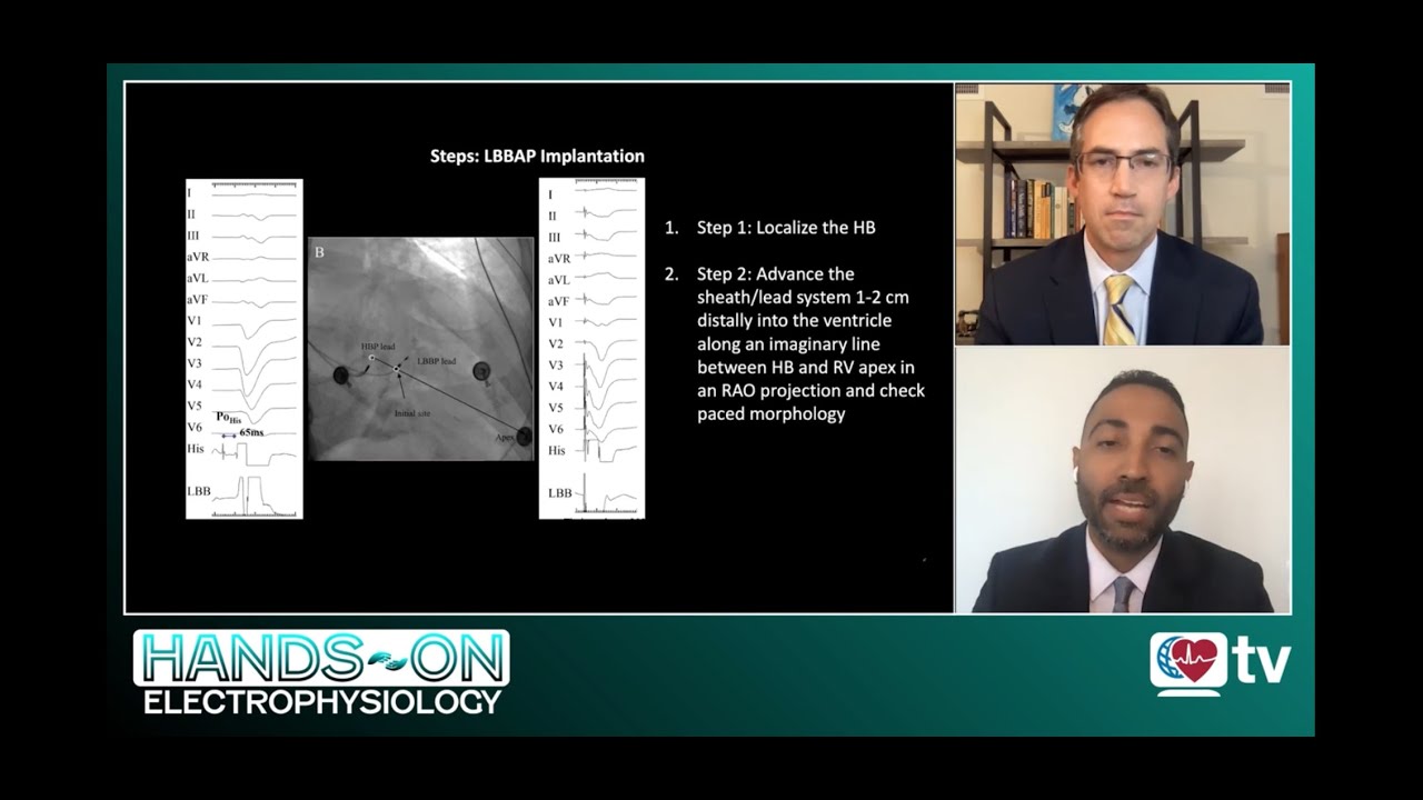 Hands-On Electrophysiology: Left Bundle Branch Pacing