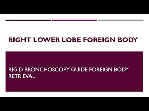 Rigid bronchoscopic foreign body retrieval