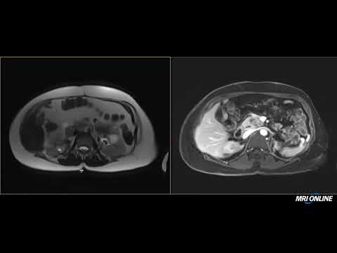 Pancreatic Cyst Review