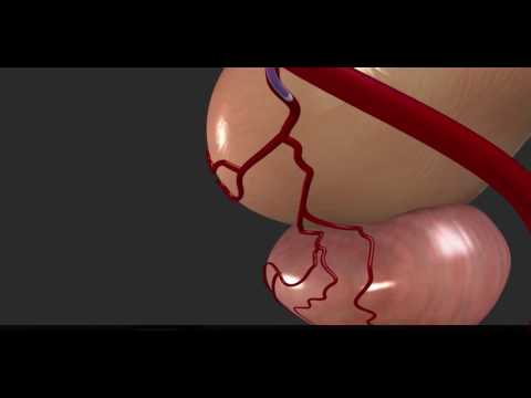 Prostate Artery Embolizatio (PAE)