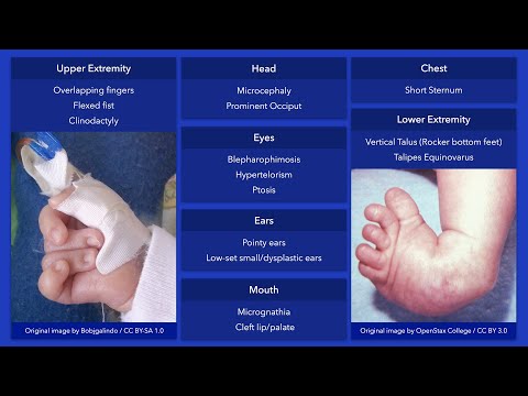 Trisomy 18 (Edward Syndrome): Dysmorphic Features