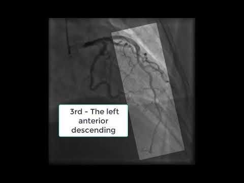 What are the 4 main coronary arteries