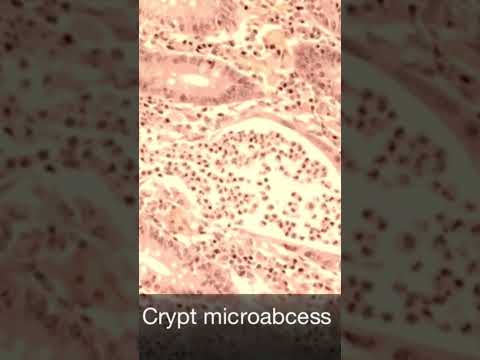 Gland crypt micro abscess in ulcerative colitis