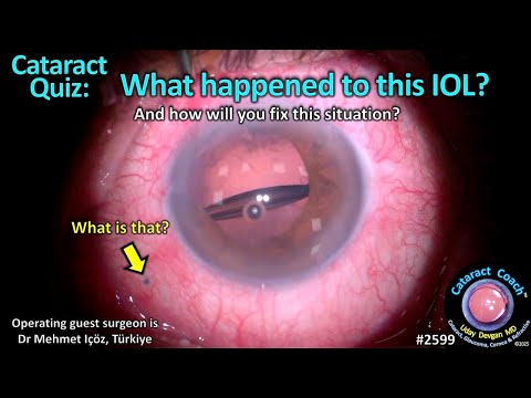CataractCoach™ 2599: CataractQuiz™: What happened to this IOL?