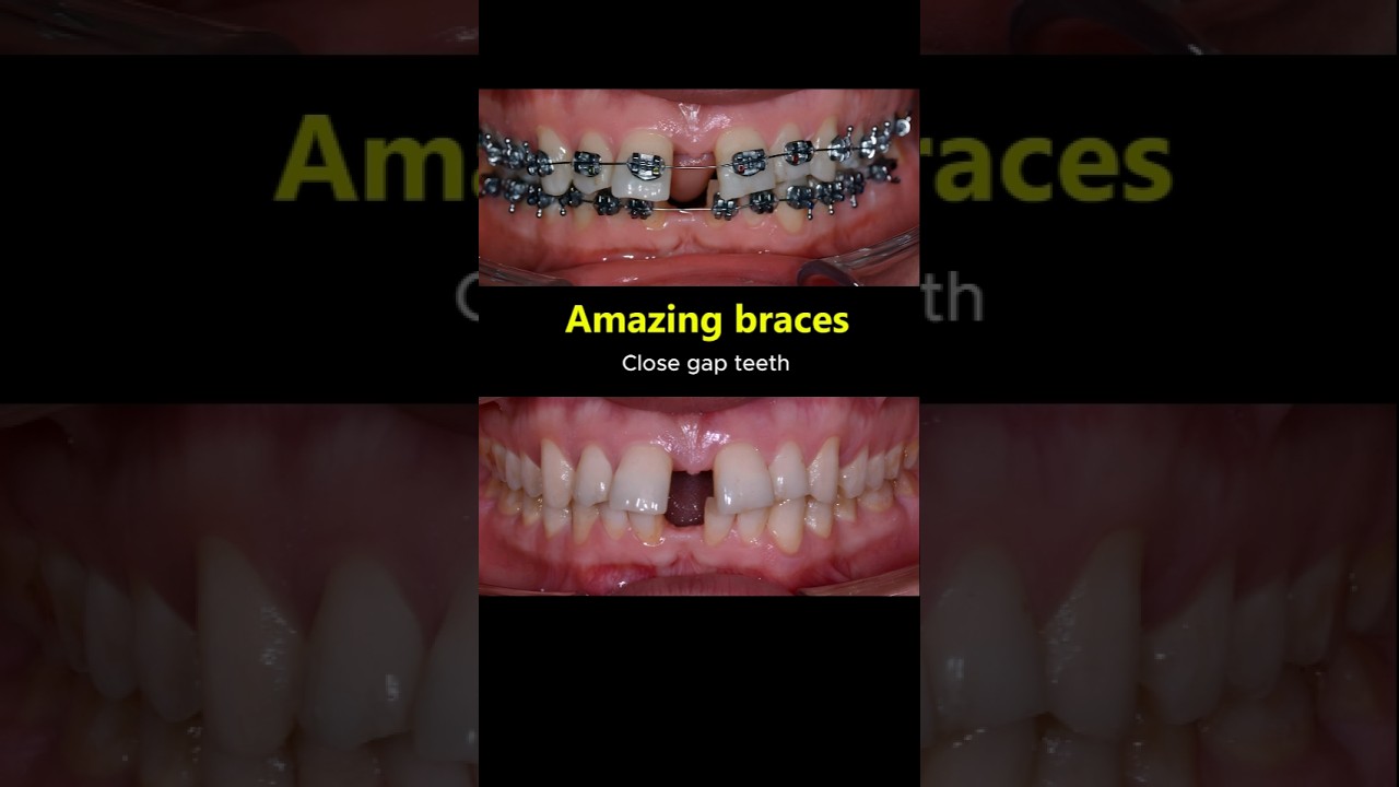 Amazing braces. Close gap teeth #orthodontist #braces #dentist