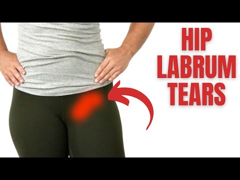 Hip Labral Tear: What It Is, How to Know If You Have It, and What To Do About It