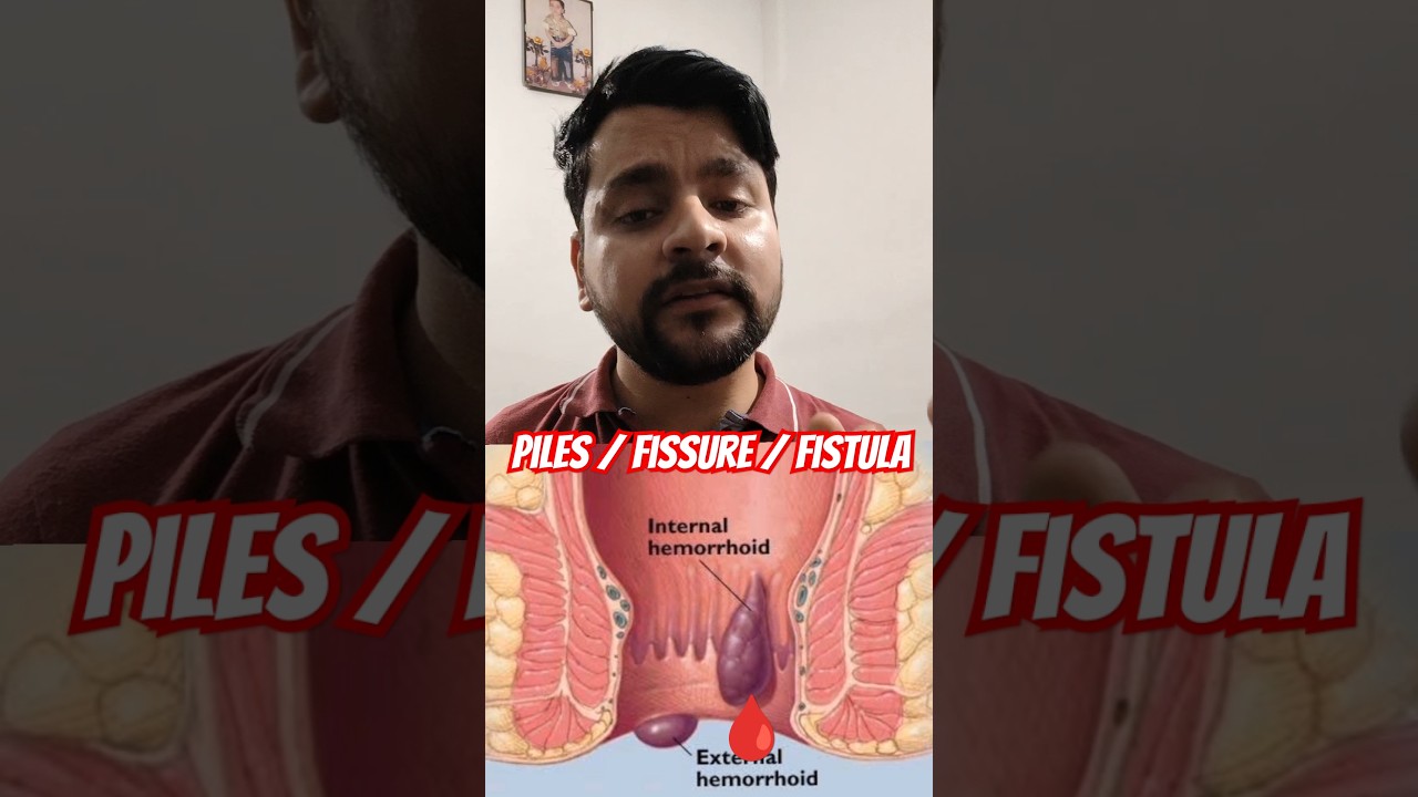 PILES Vs FISSURE Vs FISTULA : KEY DIFFERENCES EXPLAINED! 😱