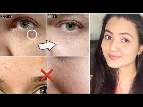 कितने भी मुश्किल MILIA मिलिया TINY BUMPS WHITE BUMPS हो, इस Remedy से होगा 100% इलाज | 100% Results