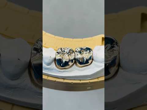 Double #Gold Crowns #dental #teeth #smile #lsk121shorts #shortvideo #shorts
