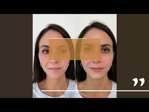 Effective Injectable Filler/Dermal Filler - Flawless Faces Med Spa - 3165 S Alma School Rd STE 29