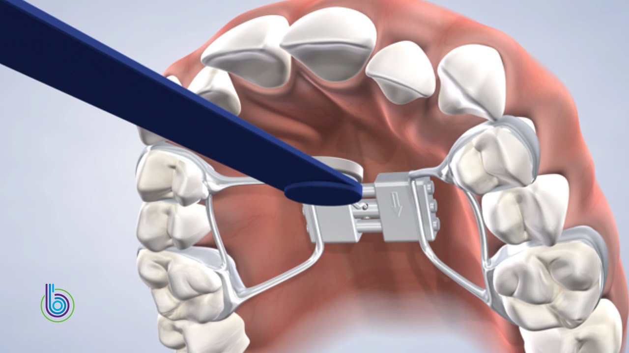 Palatal Expansion in Omaha NE: Dr. Stevens | Braces Omaha