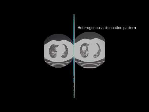 CT evaluation - expiratory air trapping