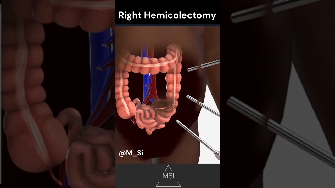Right Hemicolectomy