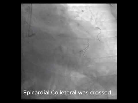 LCX CTO, Ipsilateral epicardial colleteral