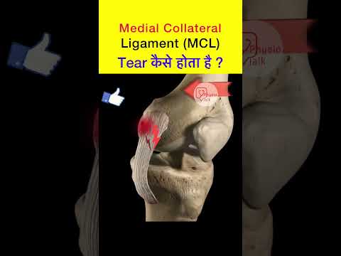 Medial collateral ligament tear कैसे होता है ? #shorts #medialcollateralligament #MCL