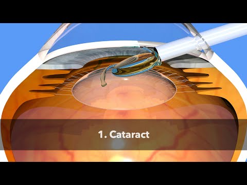 Cataract