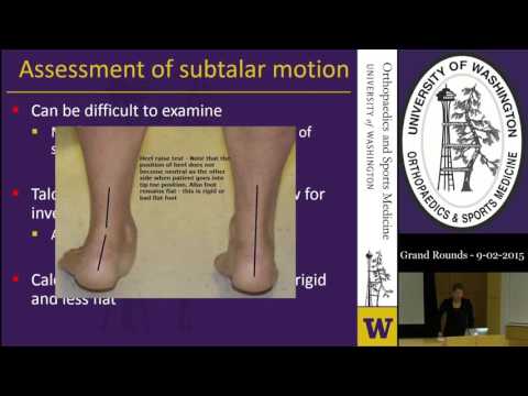 Tarsal Coalition - Pediatrics - Orthobullets