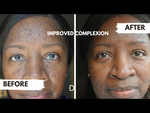 DRAMATIC IMPROVEMENT! DPNs removed.Worth it! #skincarereview #blackgirlmagic